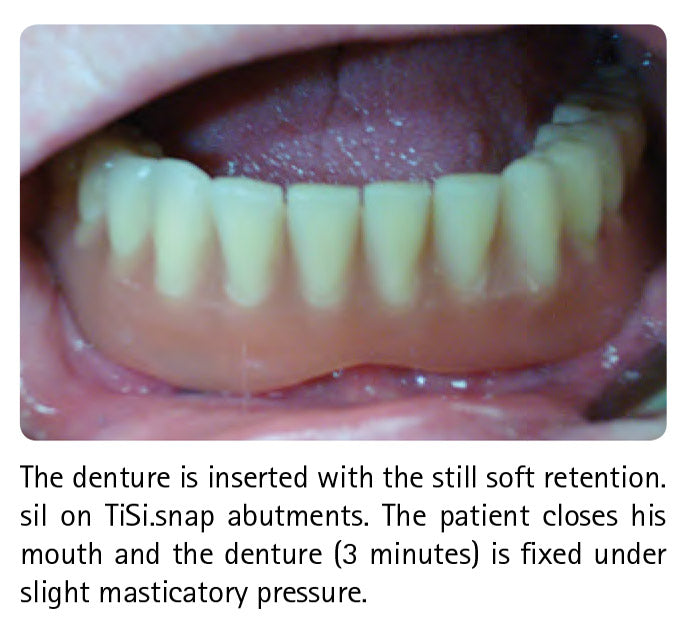 Bredent Retention.Sil 200, 400, 600, 1pc | Impulsedent Australia