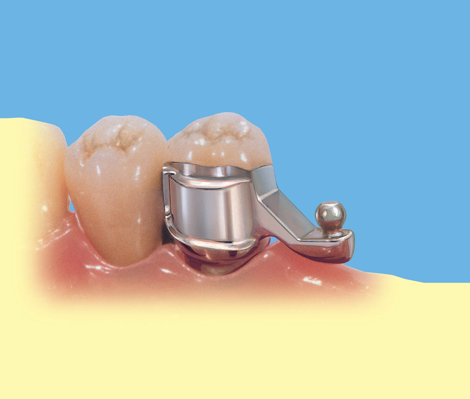 Bredent vks-oc extracoronal patrix 1.7 and 2.2, 8 pcs | Impulsedent ...