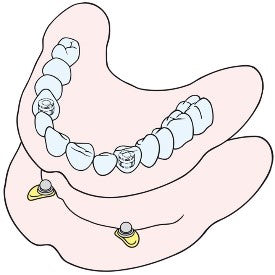 C&M Dalbo®-Plus and Dalbo®-Classic male part, 1 pc | Impulsedent Australia